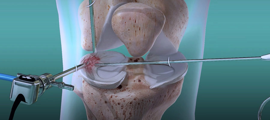 Sports Surgery Treatment - Orthomasters Istanbul